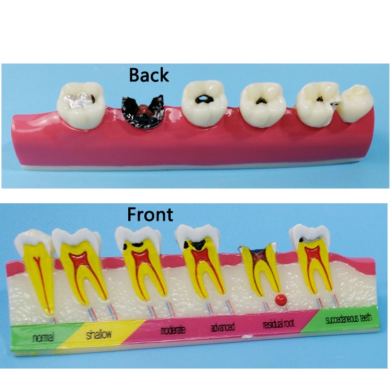 Dental Caries Classify Model Tooth Model Demonstration Teach Study ...