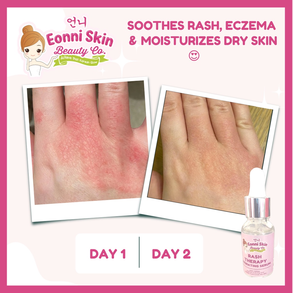 Eonni Skin Rash Therapy For Eczema And Rashes | Shopee Philippines
