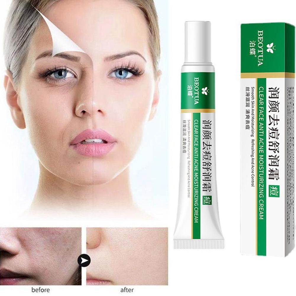 Effective Acne Removal Cream Herbal Acne Spots Oil Control Acne Cream ...