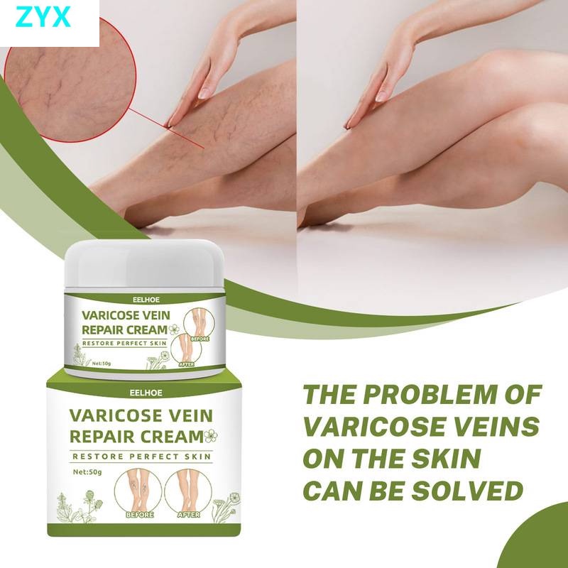 Varicose Vein Cream Leg Swelling Care Cream 50g Varicosity Angiitis ...