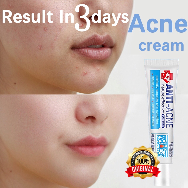 30G Acne cream pimple remover cream acne remover pimple scar remover ...