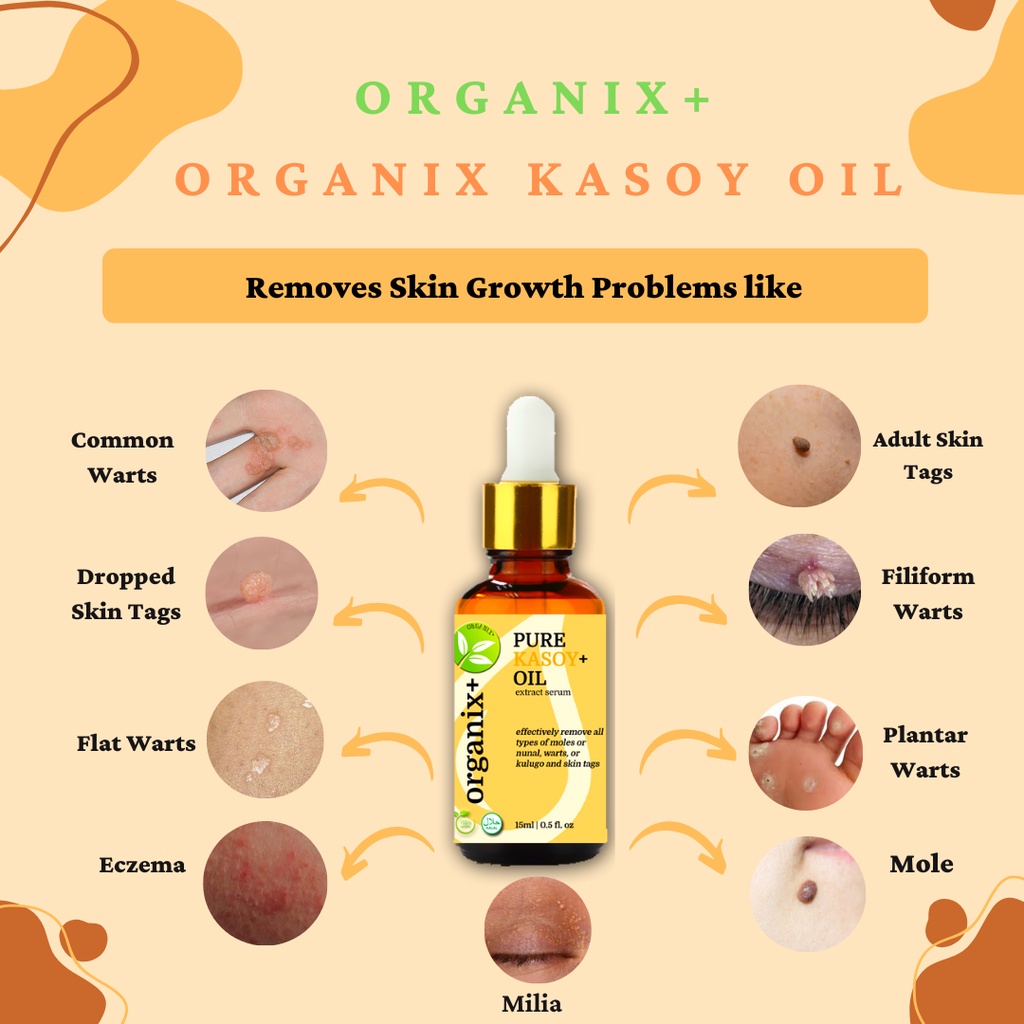 ORGANIX Original Organic Pure Cashew Oil for Warts Skin Tags Kulugo ...