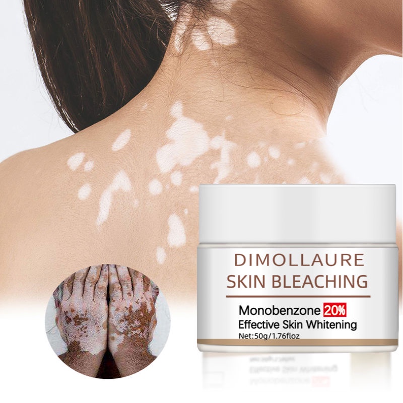 Dimollaure Monobenzone Body Whitening Cream Bleaching Vitiligo Fade ...