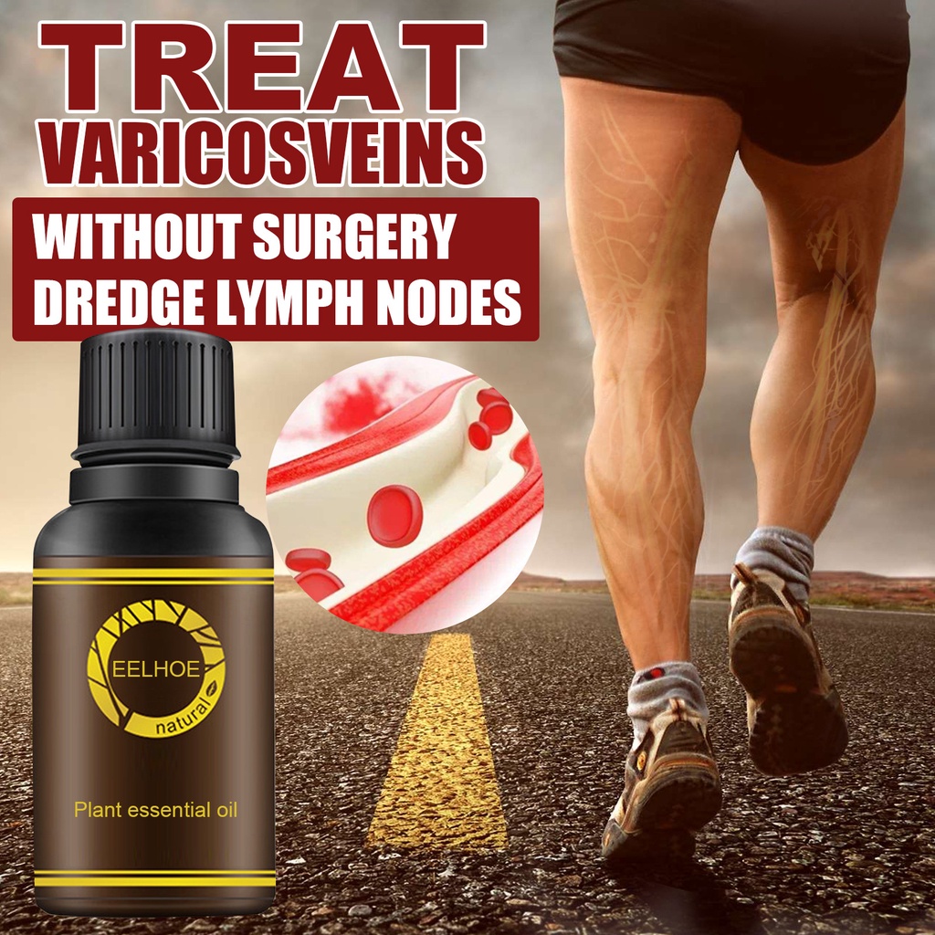 30ml Varicose Vein Treatment Essential Oil Unblocked Blood Vessels ...