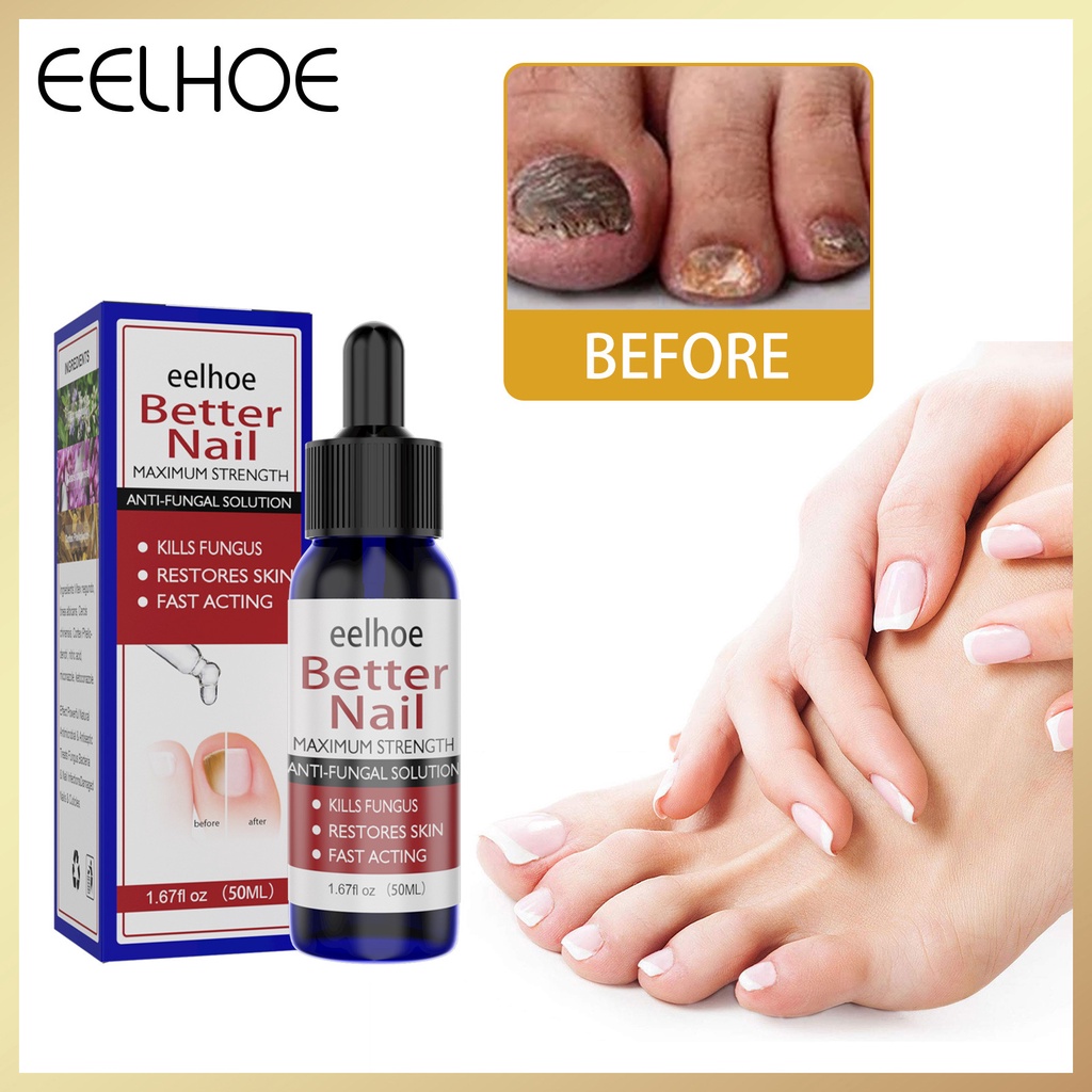 EELHOE Nail Drop Liquid Fungus Therapy Best Repair Stop Fungal Growth ...