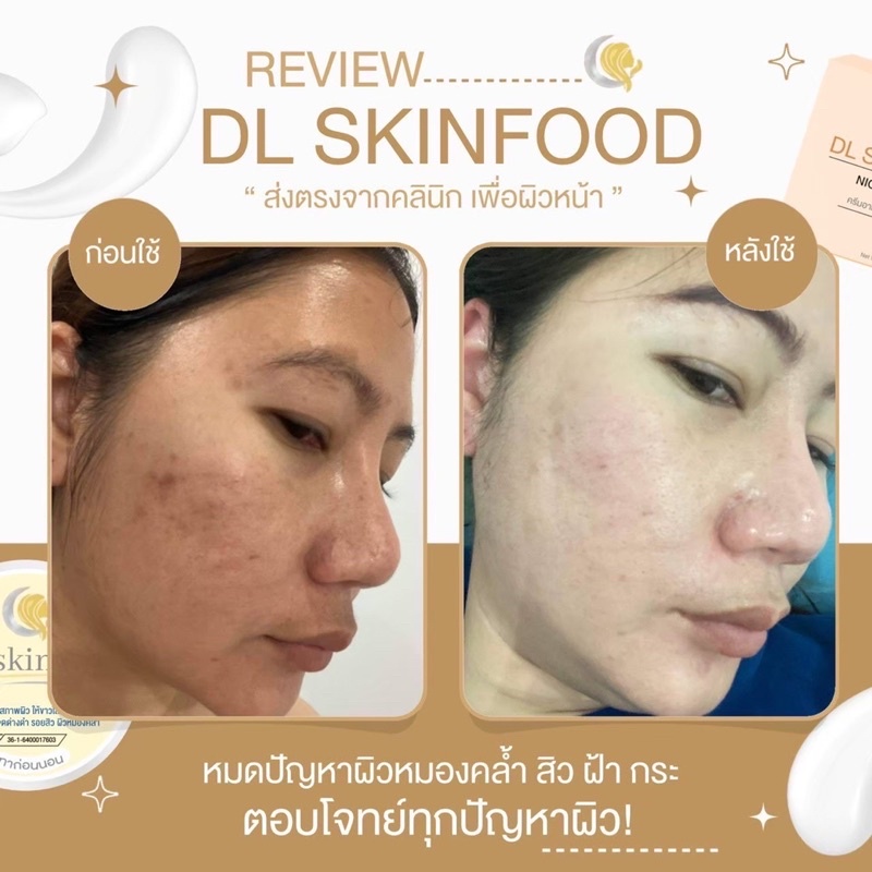 DELI SKIN NIGHT CREAM FOR ACNES/MELASMA/ DULL SKIN FROM THAILAND (5g ...
