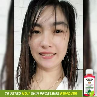 Pure Kasoy Oil - Best Wart & Mole Remover, Kulugo, Skintag, Nunal ...