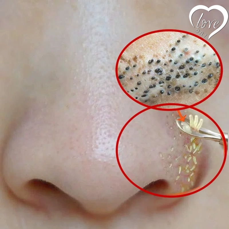3pc Spot Blackhead Nasal Patch Nasal Patch Tear Off Blackhead