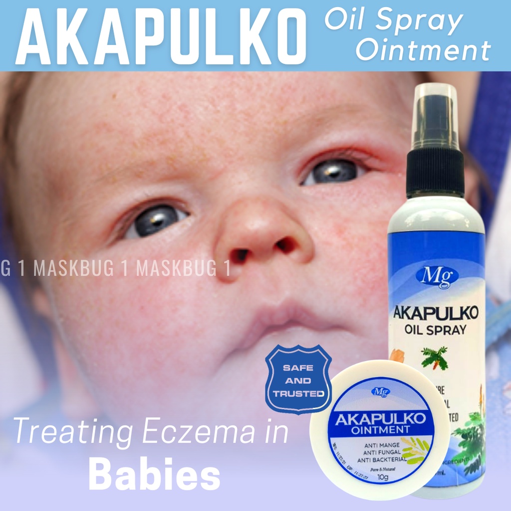 [MASKBUG 1] BUNDLE SET Akapulko Oil Spray and Ointment | Treat ...