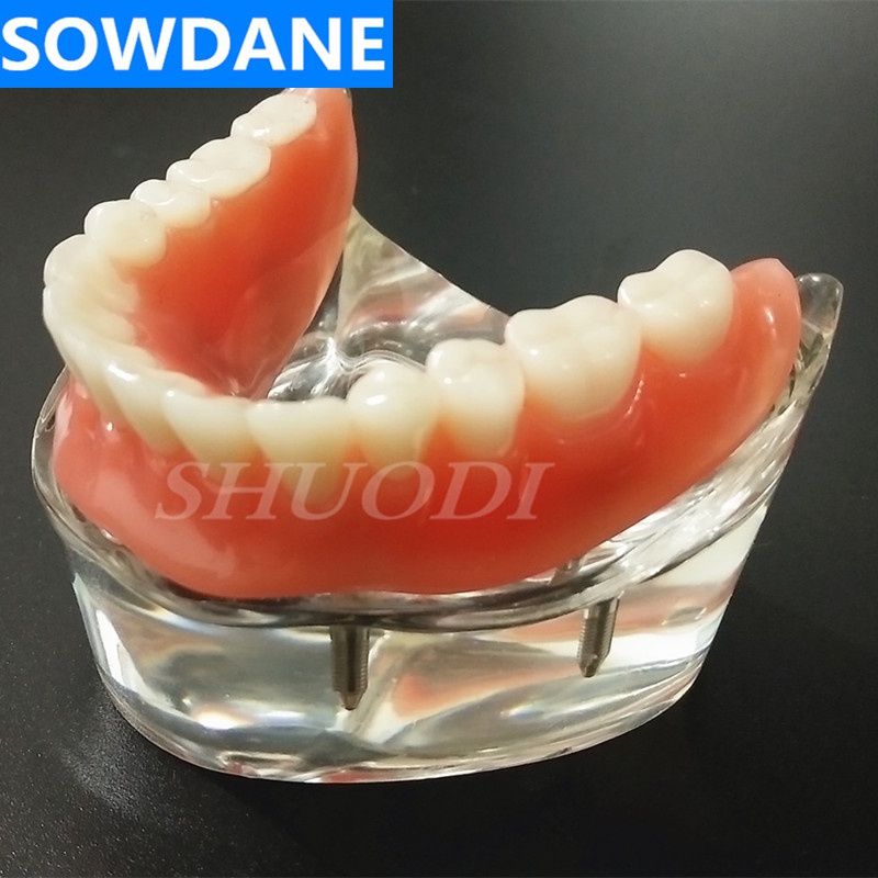 Dental Overdenture Interior Mandibular Lower with 4 Implant Restoration ...
