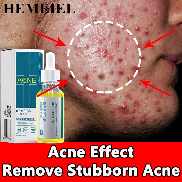 HEMEIEL Acne Treatment Pimple Remover/Face Serum Anti Acne Scar Marks ...