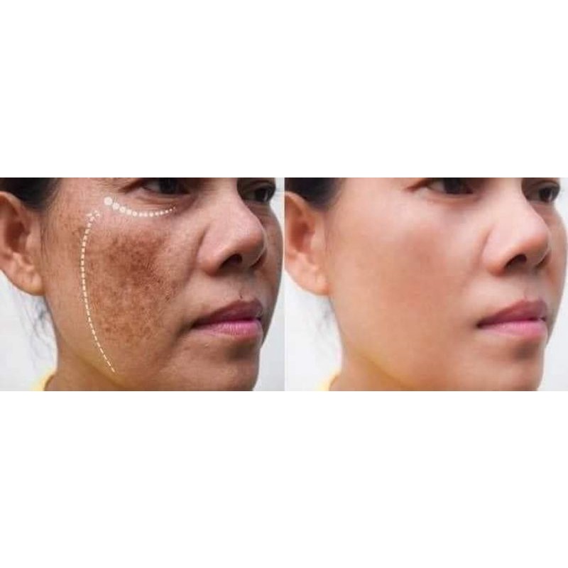SOLUTION FOR PEKAS, PIMPLES, MELASMA, PIMPLE MARKS, PEKLAT OR ANY SKIN ...