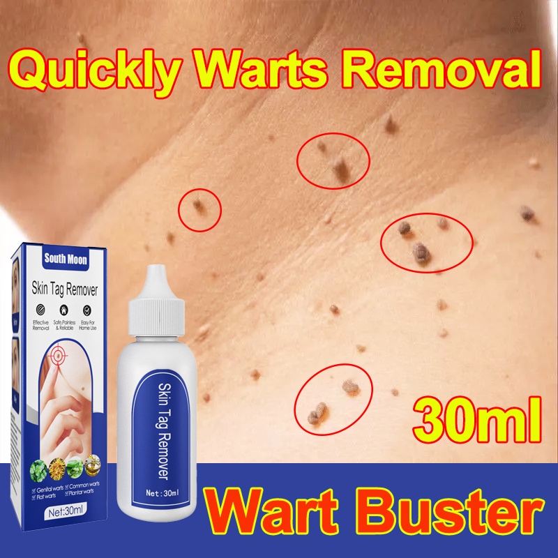 【Wart Killer】Wart Removal Origina 30ml, effectively remove and cure ...
