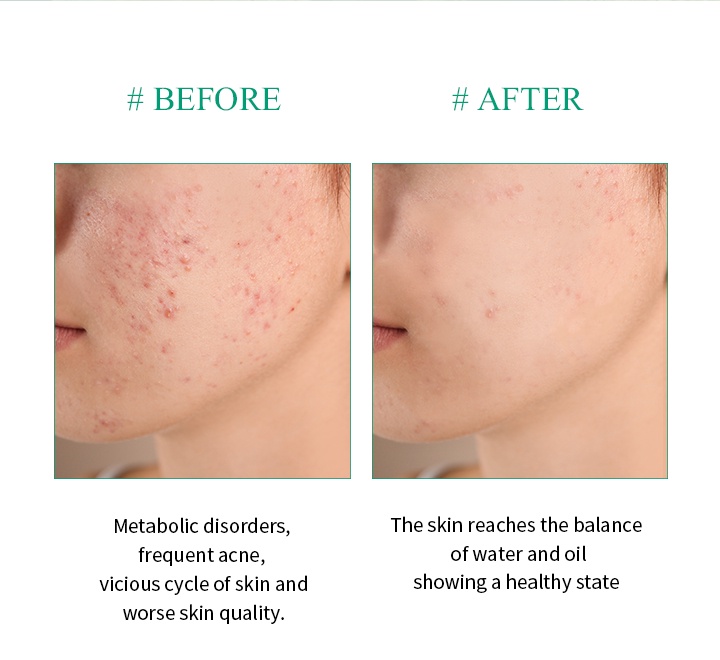 BREYLEE Acne Toner Facial Toner Acne Treatment Tea Tree Original ...