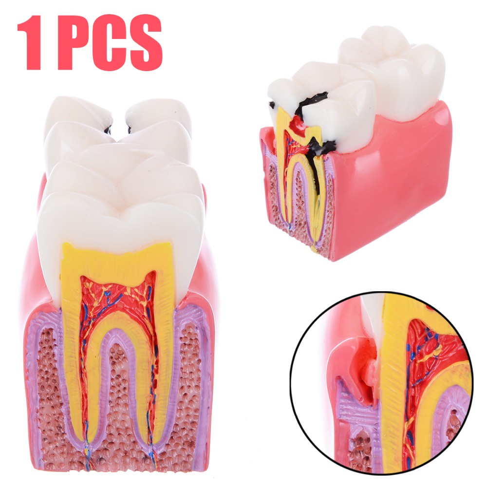 6 Times Dental Caries Comparsion Models Tooth Decay Model for Study ...