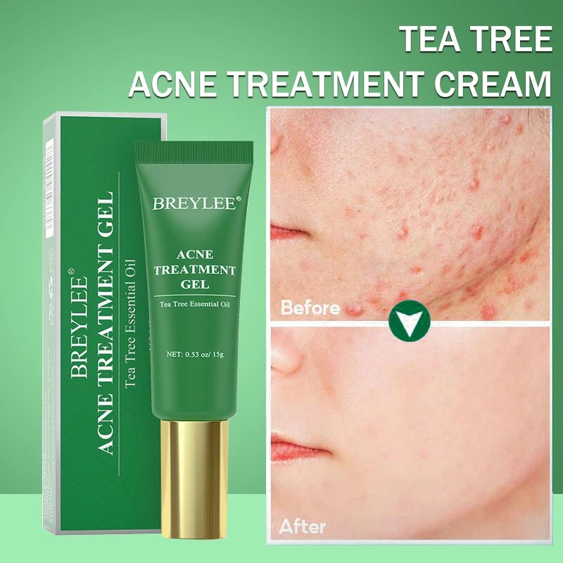 BREYLEE Tea Tree Acne Removal Gel Effective Treatment Face Pimple Marks Removal Gel Anti-Acne ...