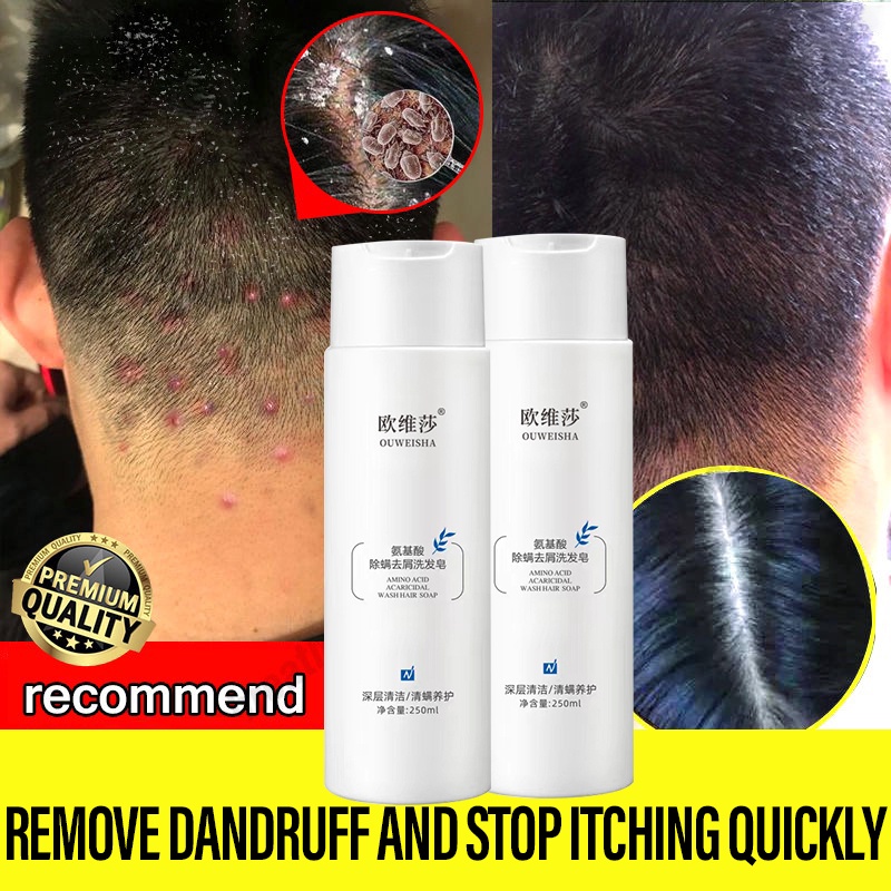 250ML Psoriasis Shampoo Anti dandruff Amino acid shampoo Removes mites ...