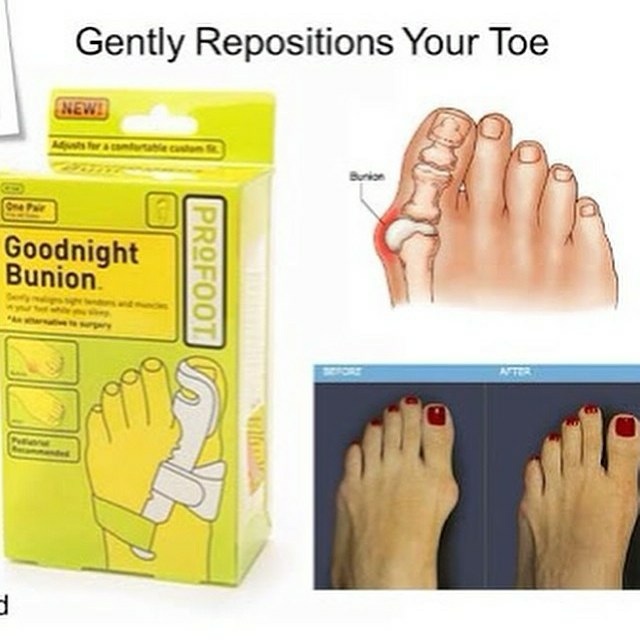 Goodnight bunion for foot | Shopee Philippines