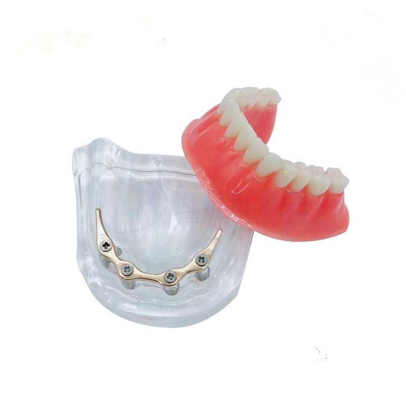 Overdenture implant model Denture Teeth mandibular model with golden ...