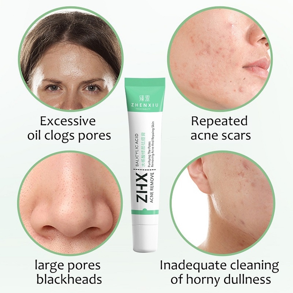 Salicylic Acid Acne Cream Remove Blackhead Oil Control Anti-Acne ...