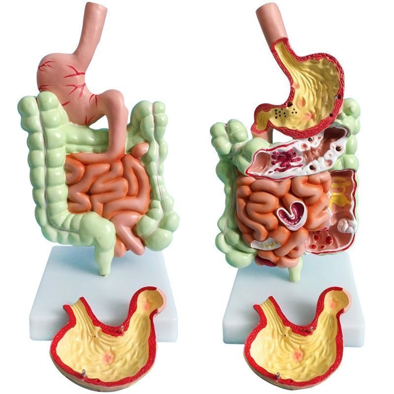 Yixi Large Intestinal Disease Model Gastrointestinal Anatomy Human Body ...