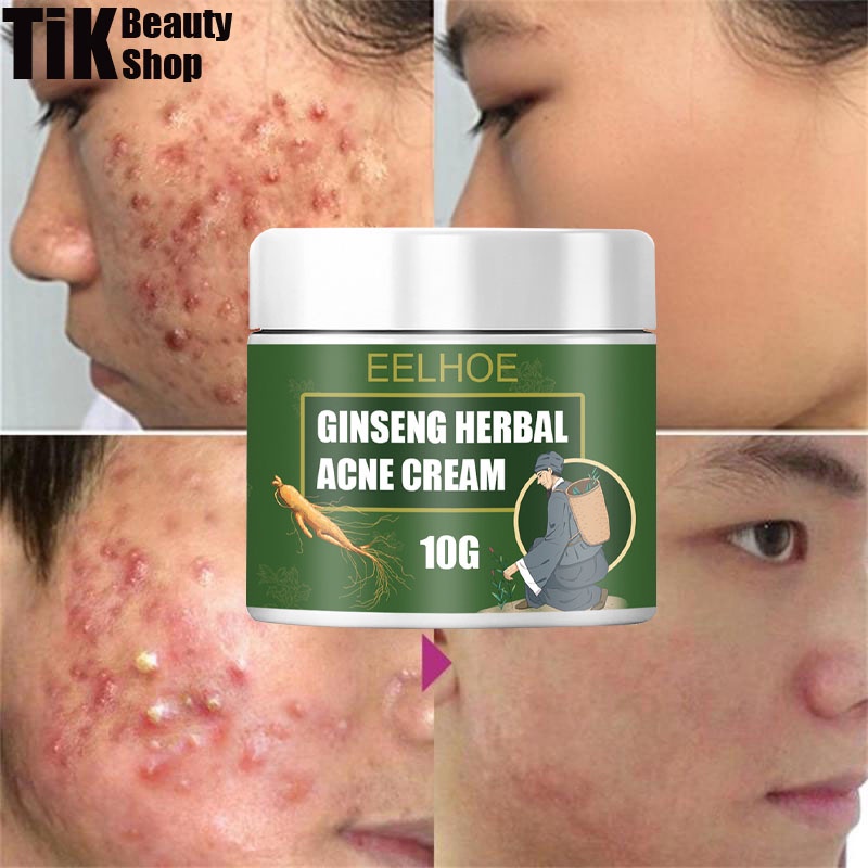 Effective Acne Treatment Cream Herbal Anti-acne Fade Acne Scar Spots ...
