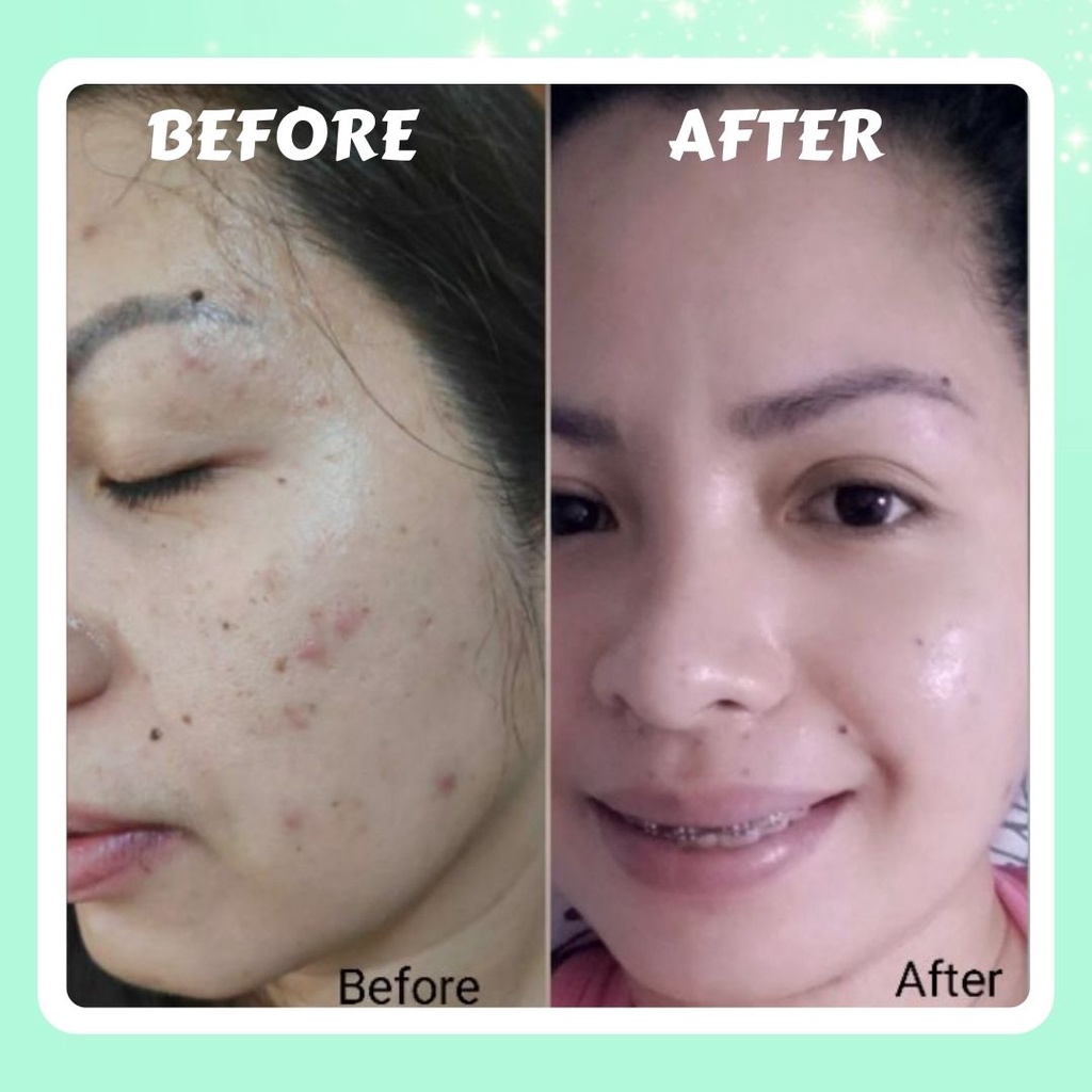 FDA Approved - Clarity Essentials Set | Clarity Facial set | Clarity ...