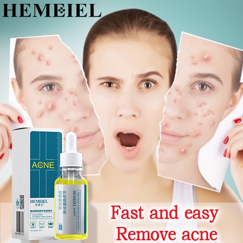 HEMEIEL- Plant acne repairing cream,acne scar remover pimple marks ...