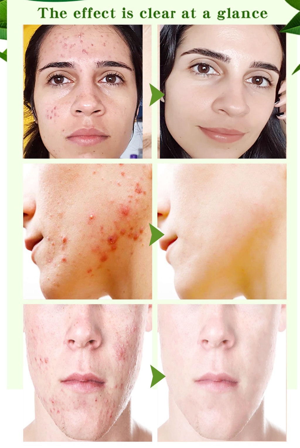 MABREM Peptide Acne Treatment Essence with Salicylic Acid and Tea Tree ...