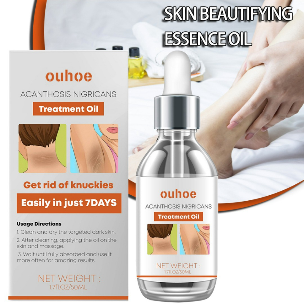 Acanthosis Nigricans Treatment Oil Knee Body Bleaching Dark Knuckle ...
