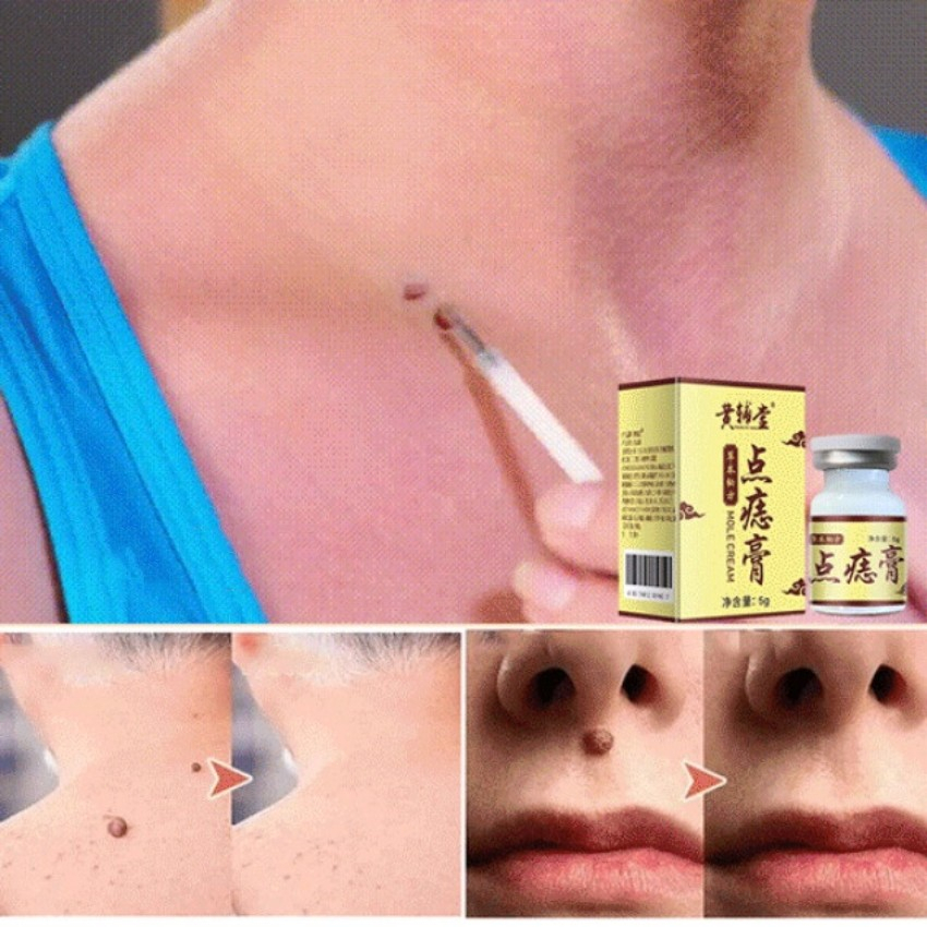 Concentrated Potent Skin Tag Removal Cream Body Warts Cream Spot Mole ...