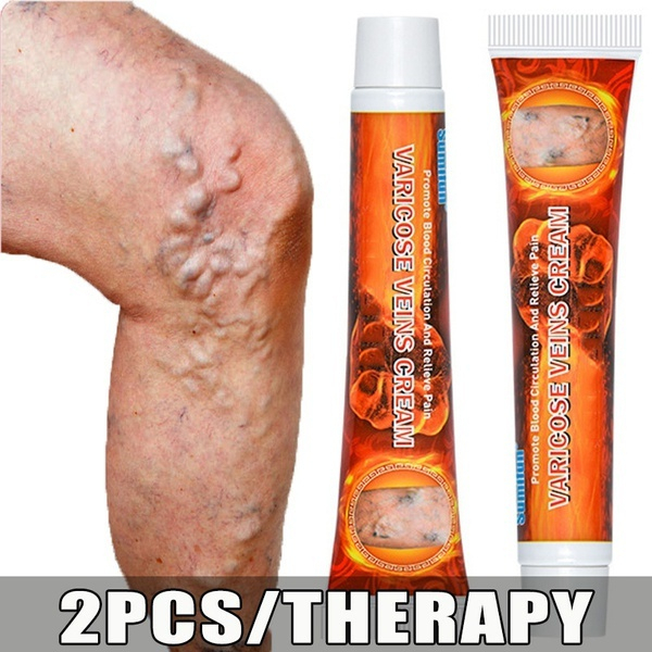 20g Varicose Veins Ointmnet Vasculitis Phlebitis Spider Cream ...