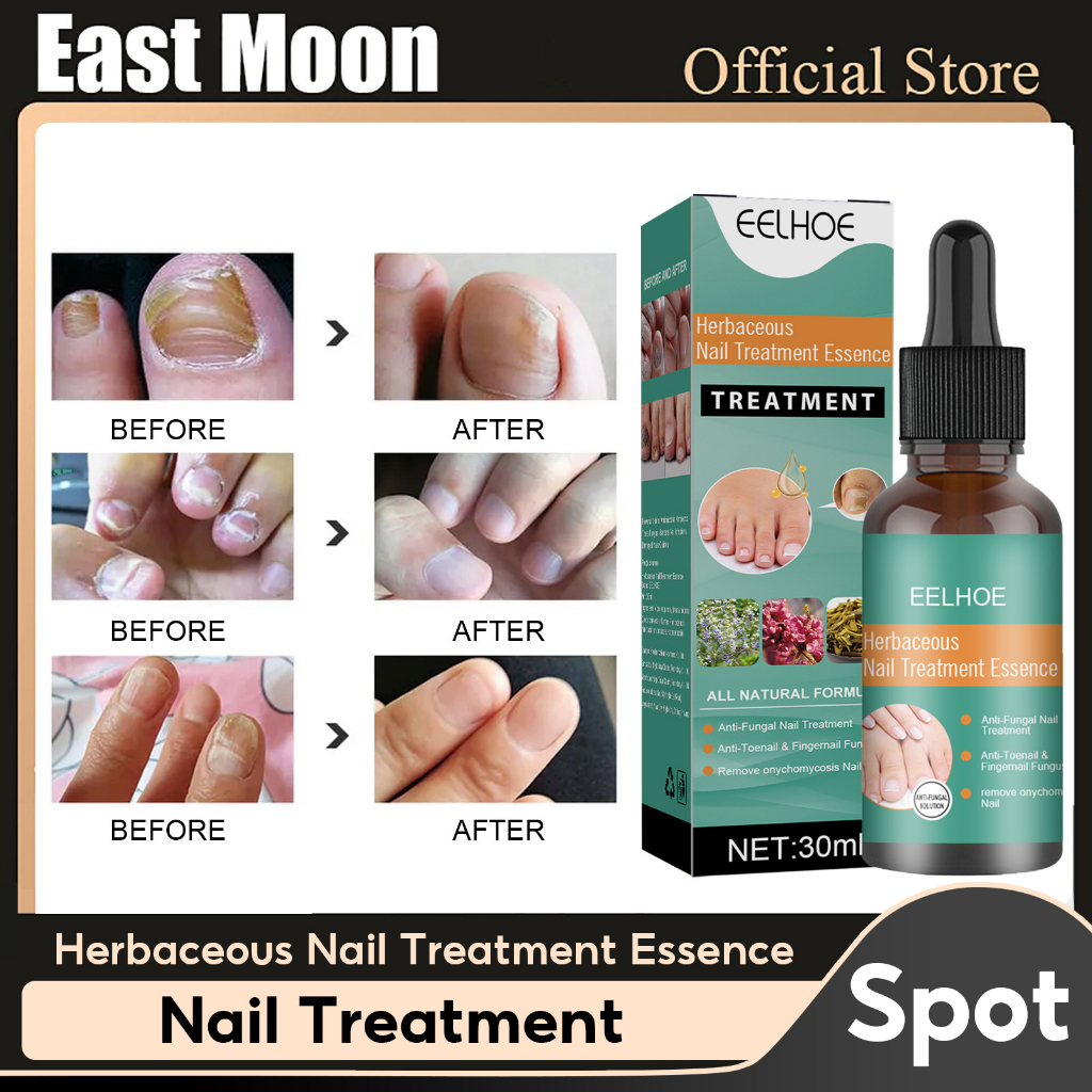 Nail Fungus Treatment solution Best Nail Repair Stop Fungal Growth ...