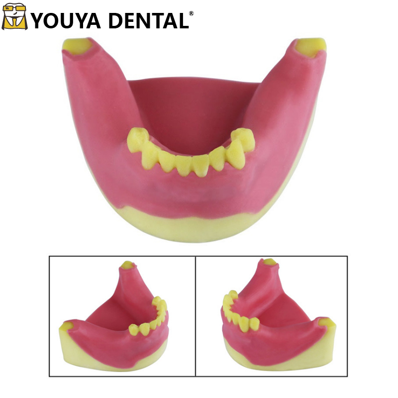 Dental Implant Model Bone Defect Supplementary Training Model Practice ...