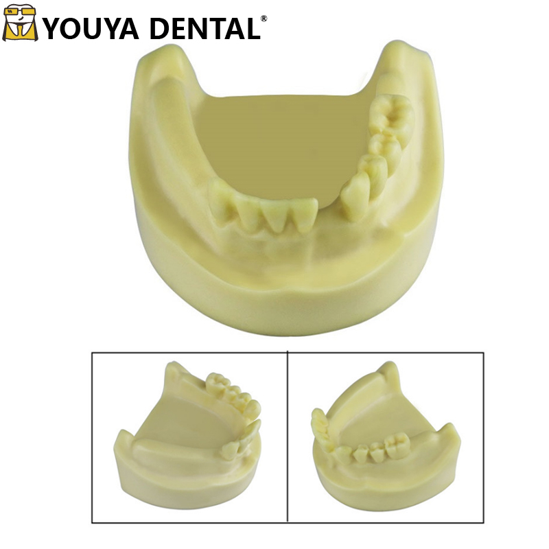 Lower Jaw Dental Practice Model Implant Model Missing Tooth Teeth Model ...