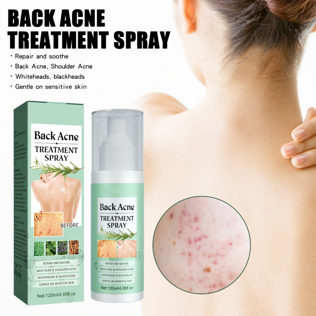 Back Acne Treatment Spray Salicylic Acid Deep Clean Body Exfoliator ...