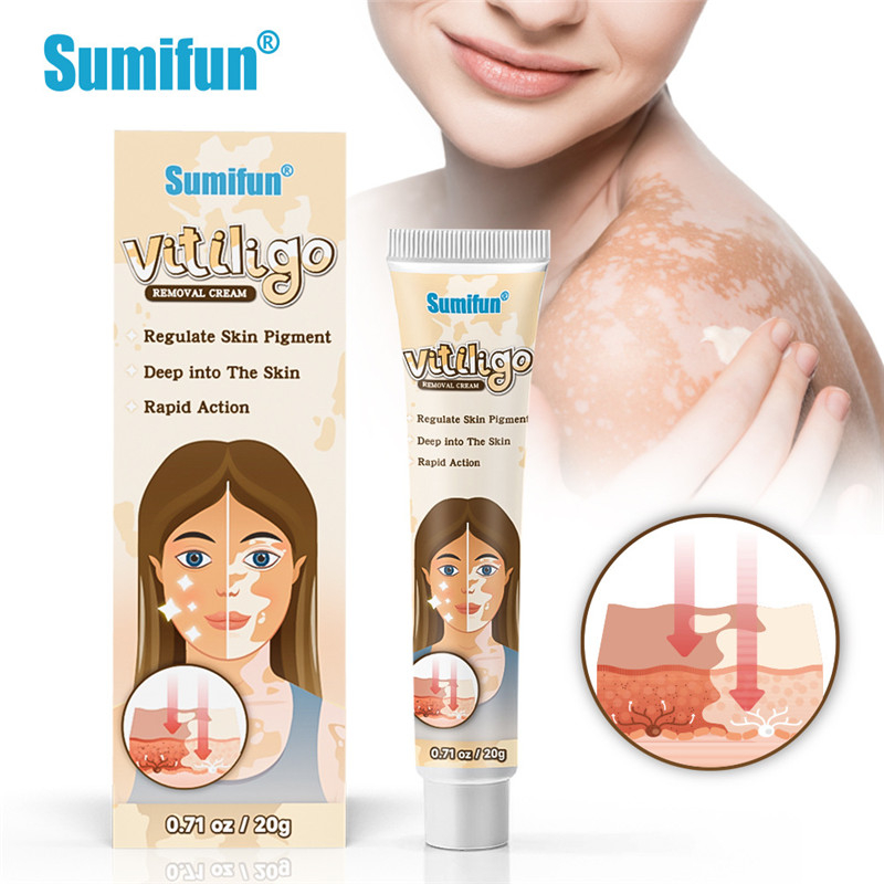 Sumifun Vitiligo treatment cream vitiligo cream remove white spot Ubat ...