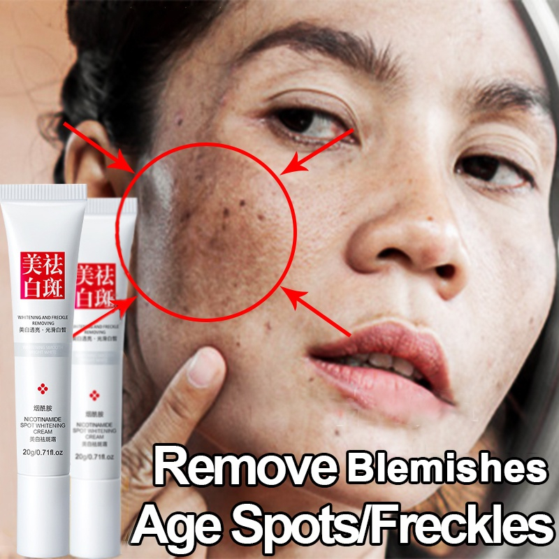 Freckle Removal Cream Whitening Anti Melasma Removal and Dark Spots ...