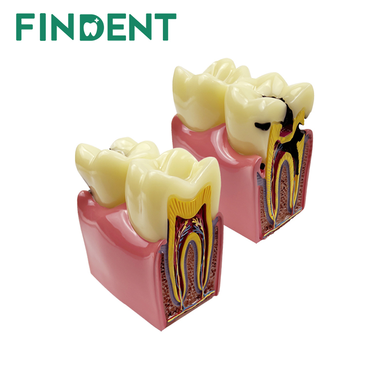Tooth Gum Model Dental Caries Comparative Study Model Tooth Decay Model ...