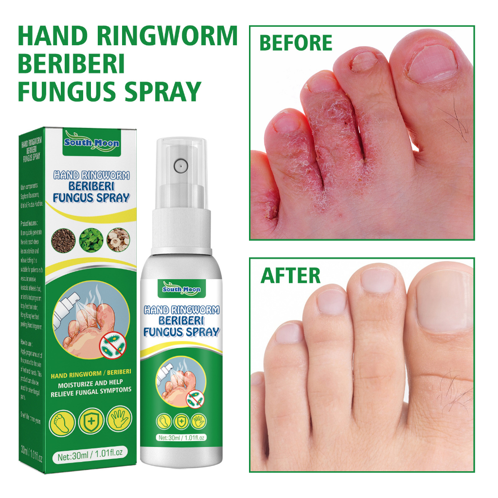 Hand Ringworm Beriberi Fungus Spray, Herbal Antipruritic Beriberi Spray ...