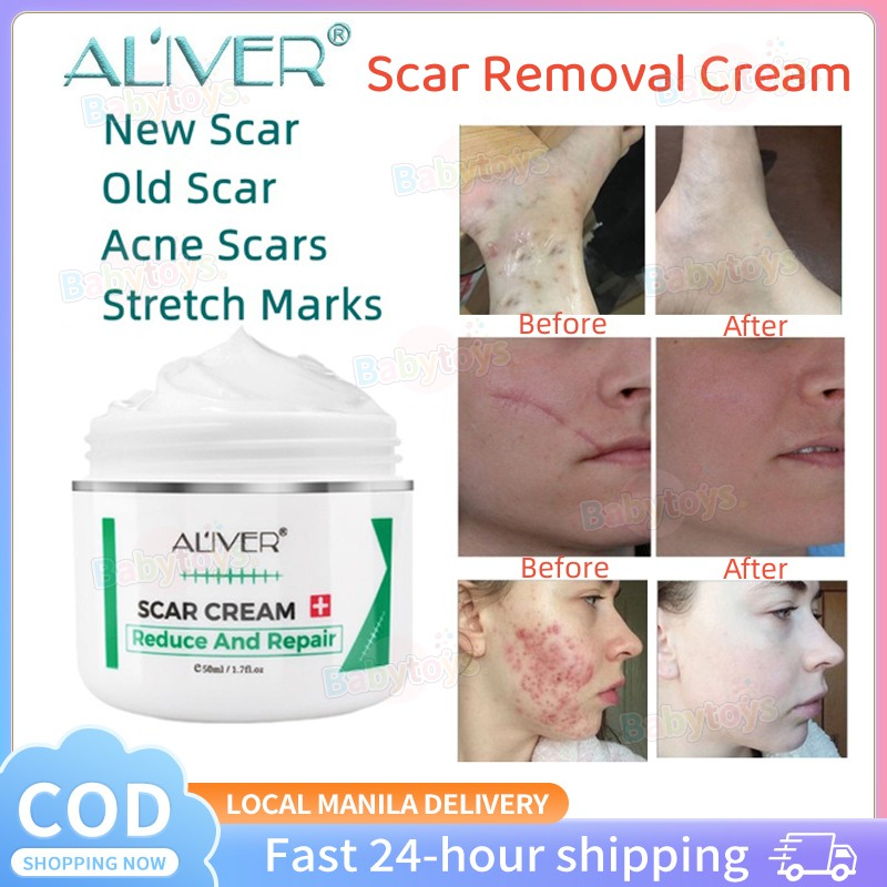 ALIVER Old Scar Remover Cream for Legs Peklat Remover Acne Treatment ...