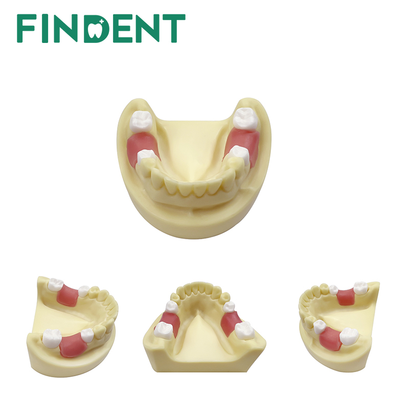 1pc Lower Jaw Teeth Model Dental Practice Model Implant Model Missing ...