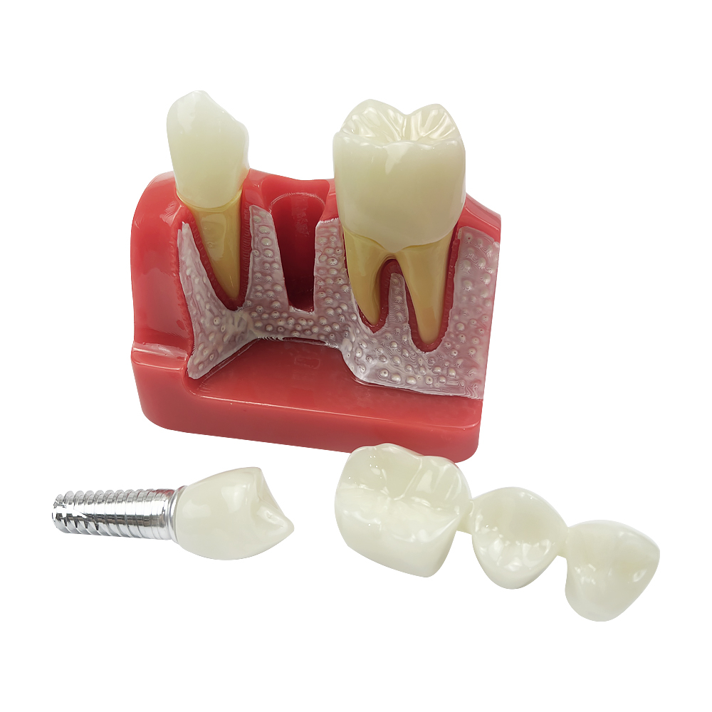 Dental Implant Model 4 Times Removable Analysis Crown Bridge ...
