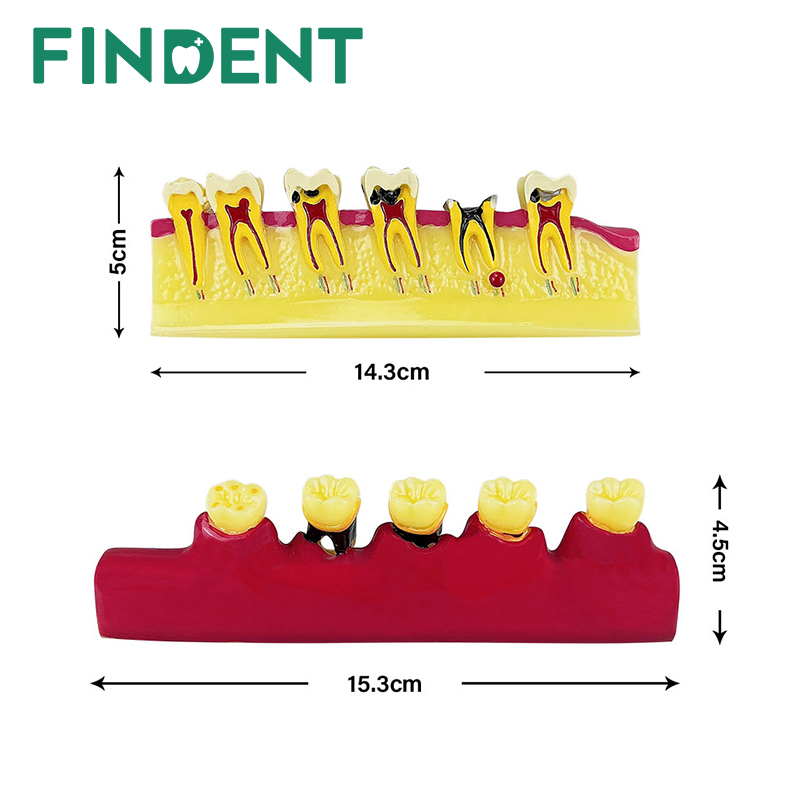 Teeth Periodontal Disease Model Dental Caries Breakdown Display ...