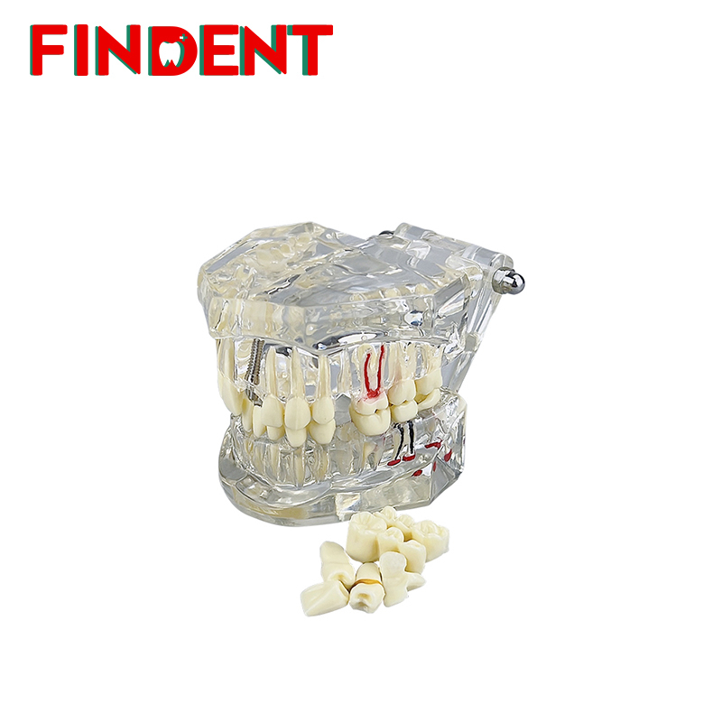 Dental Oral Typodont Model Implant Pathological Removable Teach Demo ...