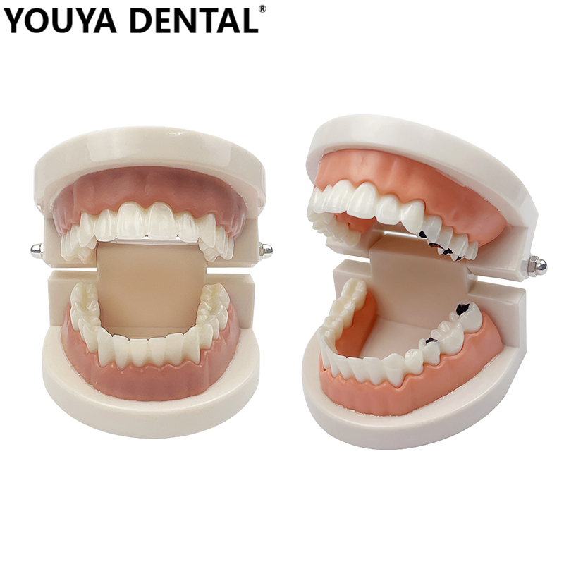 Dental Study Model Teaching Teeth Model Caries Tooth Model Decayed ...