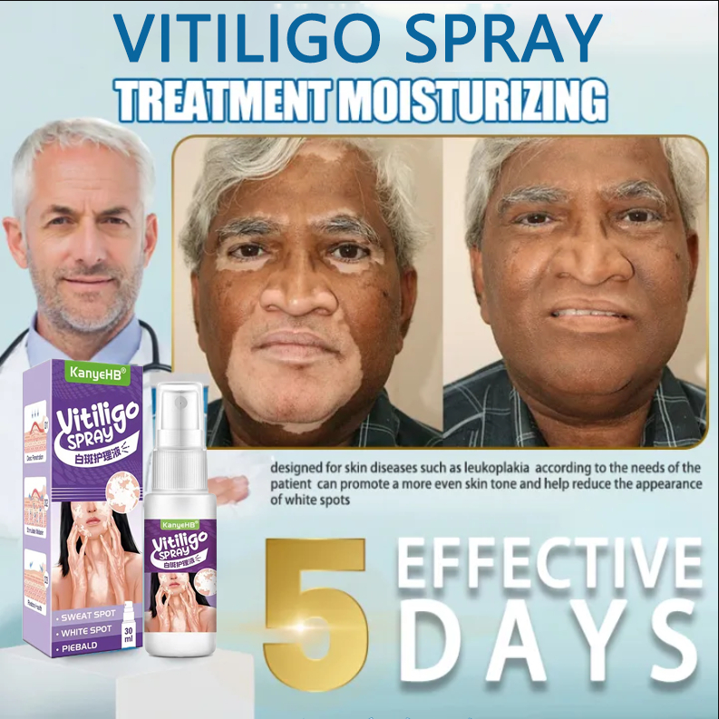 Vitiligo Cream Vitiligo Treatment Spray White Spots Tag Remover ...