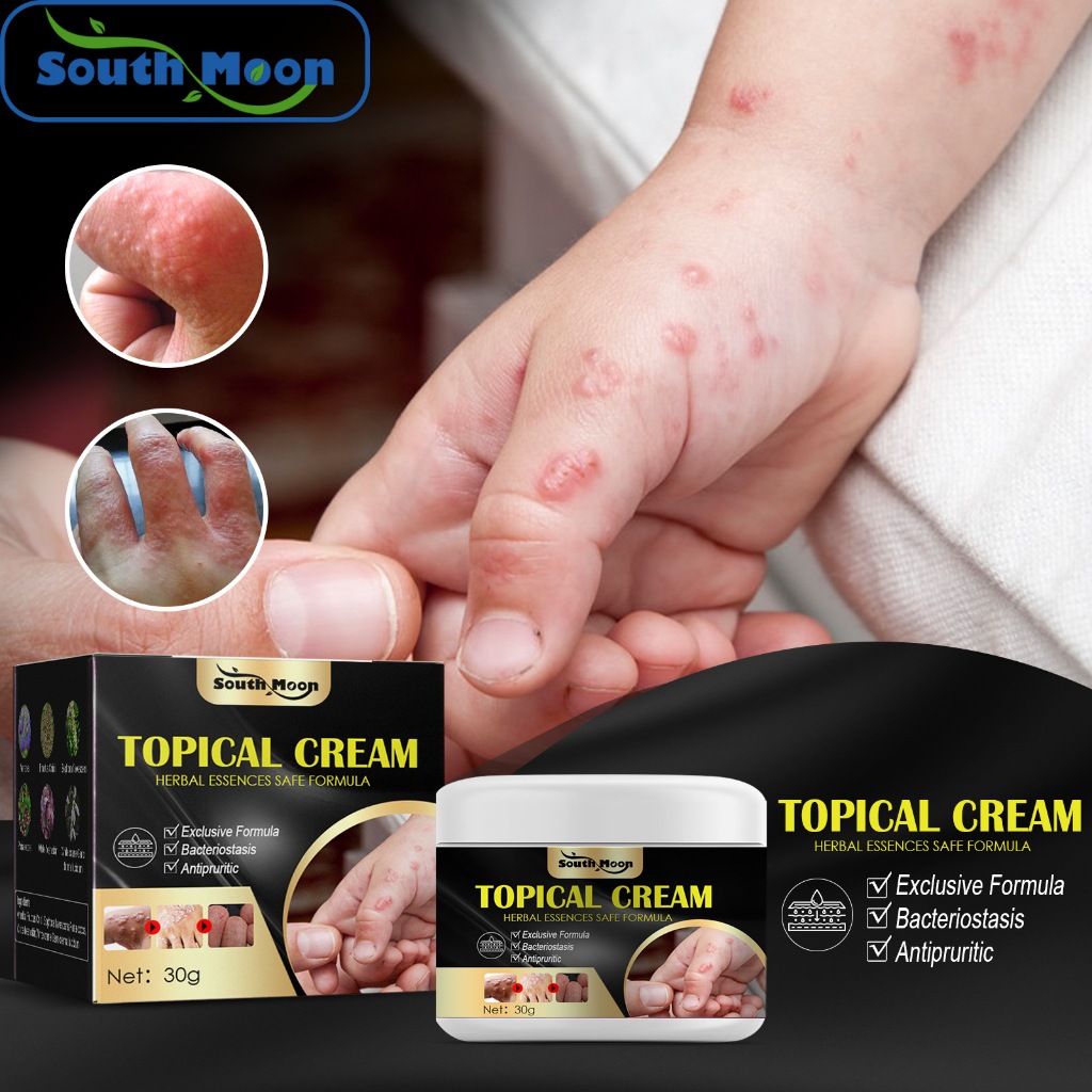 South Moon Topical Cream 30g Hand-Foot Itch Relief Cream Skin Dry Itchy ...