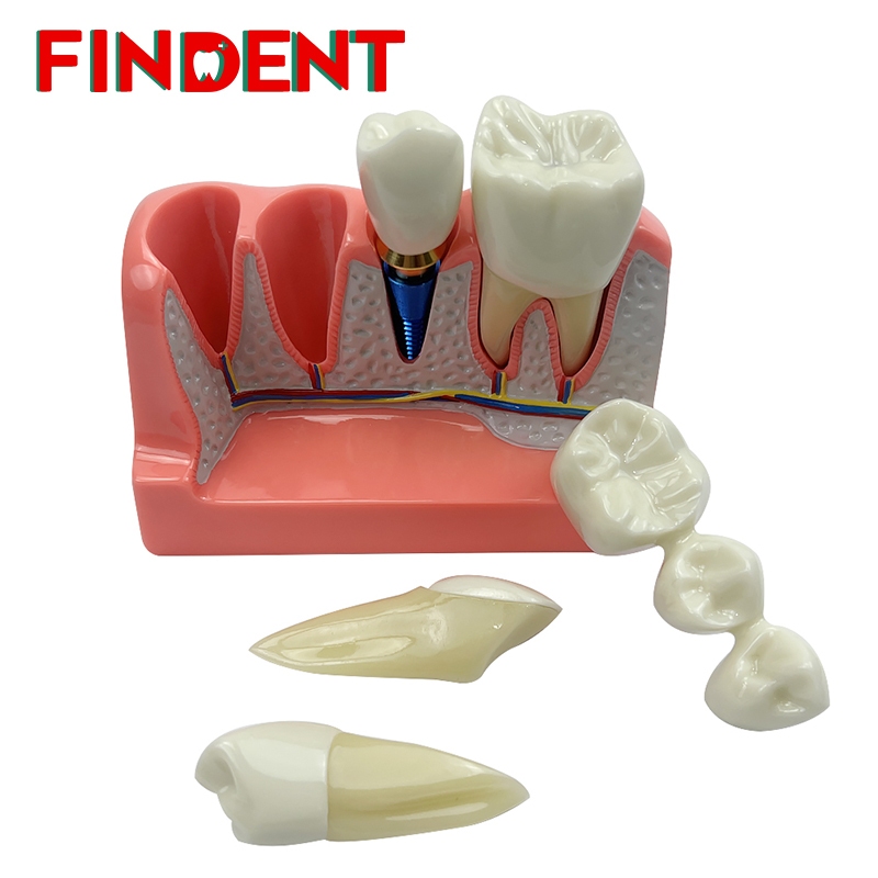 4 Times Dental Teaching Model With Removable Teeth Implant Model Dental ...