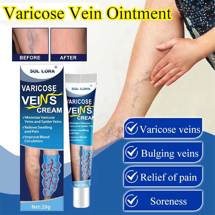 Blue Veil Vein Cream Cream for Earthworm Legs Varicose Veins Varicose ...